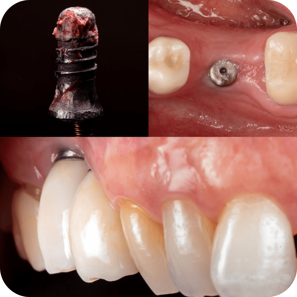 Dental Implant Training Courses & CE | Misch Implant Institute