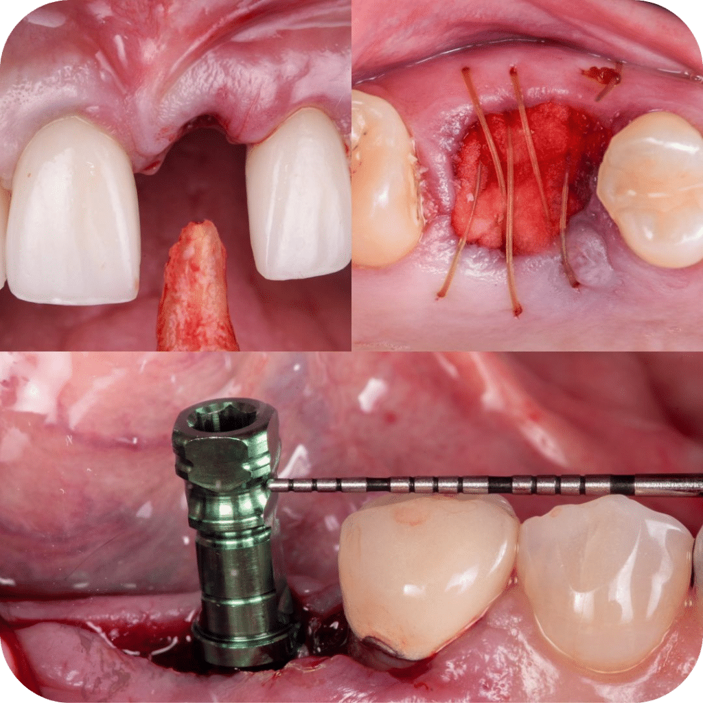 Dental Implant Training Courses & CE | Misch Implant Institute