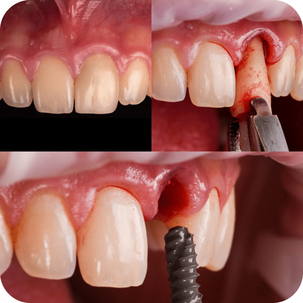 Dental Implant Training Courses & CE | Misch Implant Institute